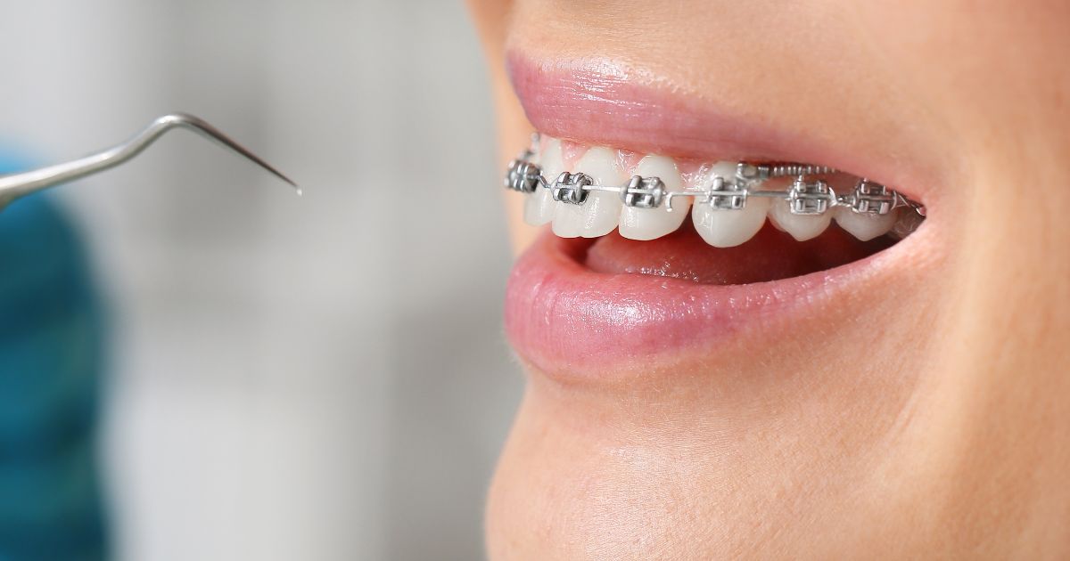 Scared of Braces? | Overcome the Fear with these Tips